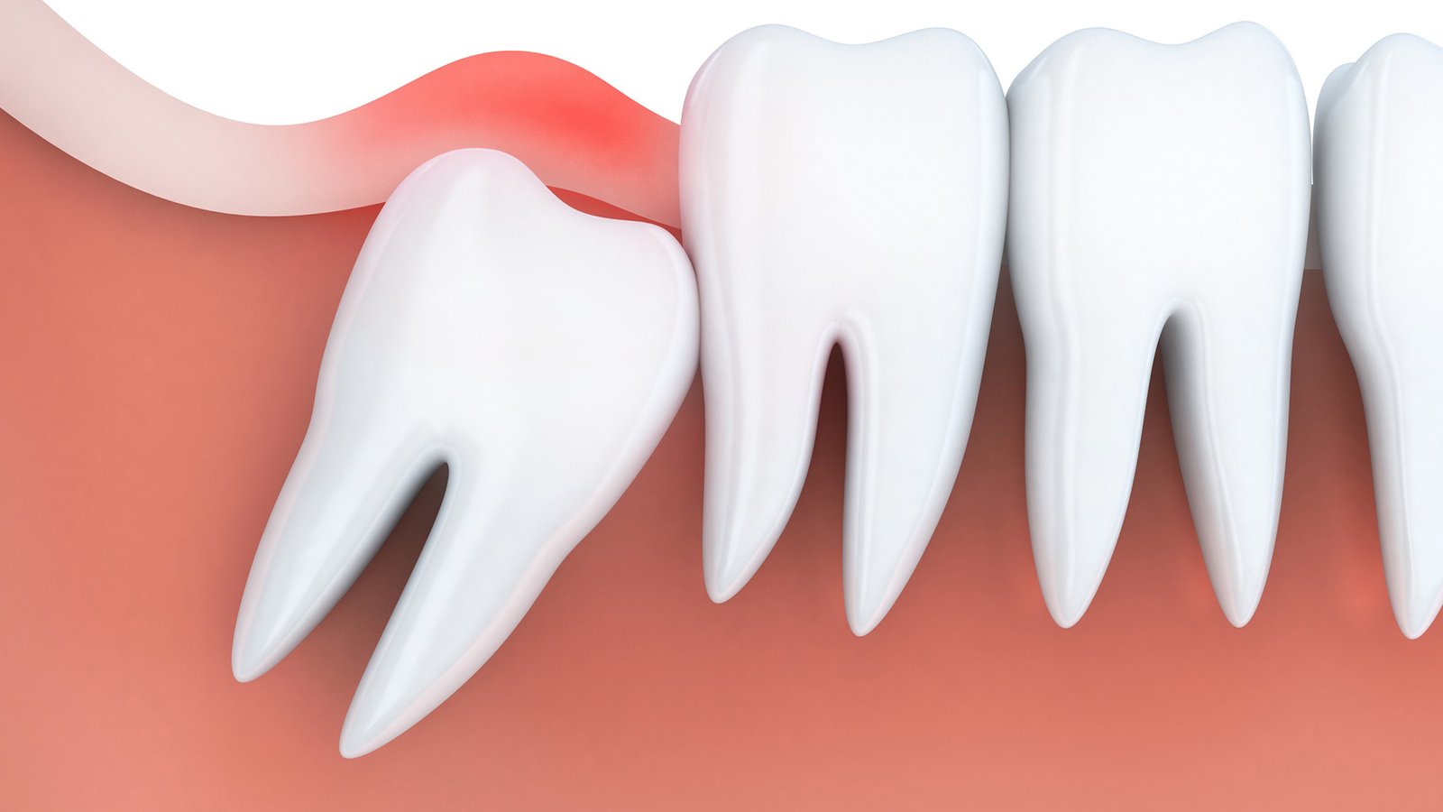 Extractions - Dr. Salim Nasser | Dentists in Markham - Dental Fillings ...